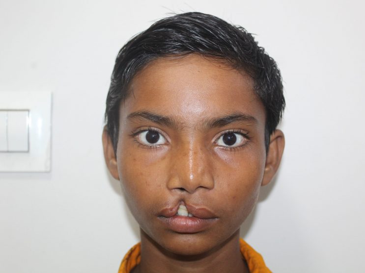 Why we should no longer call cleft lip a “harelip” – Deutsche Cleft ...