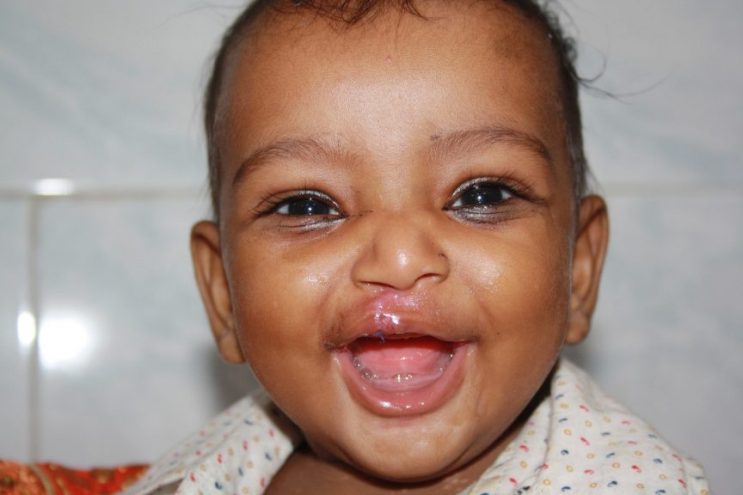 Born with cleft lip and palate in India: Ashmitas story. – Deutsche ...