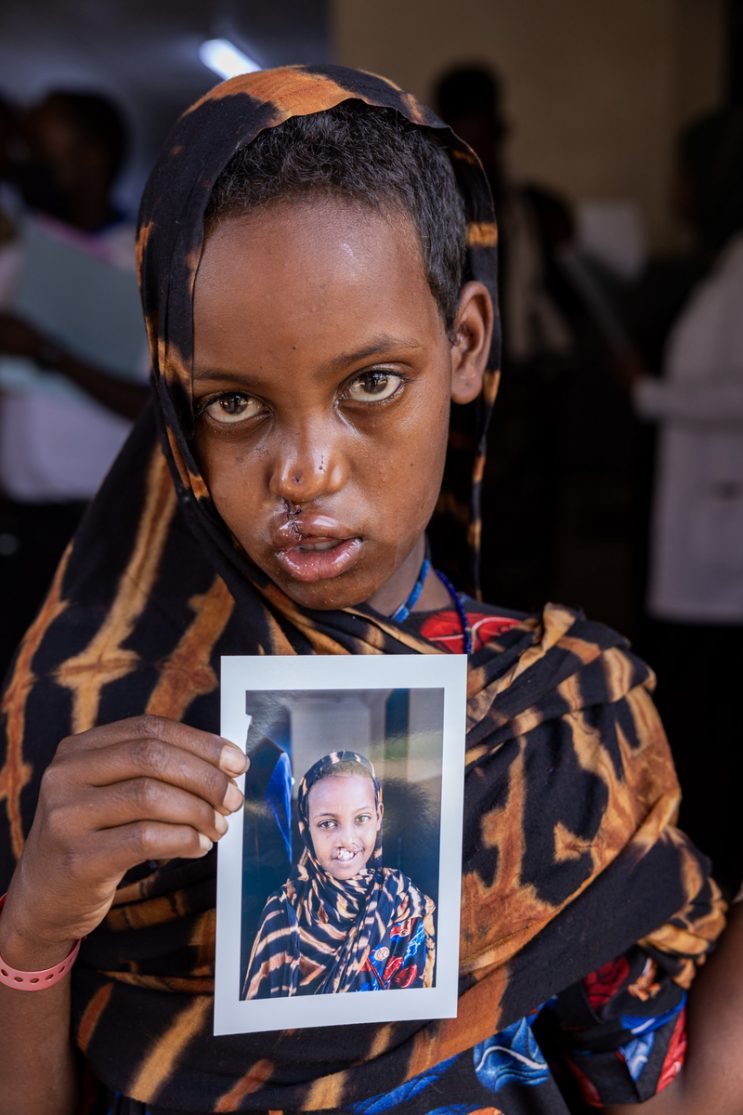 Second cleft care mission to Jijiga, Ethiopia – Deutsche Cleft ...